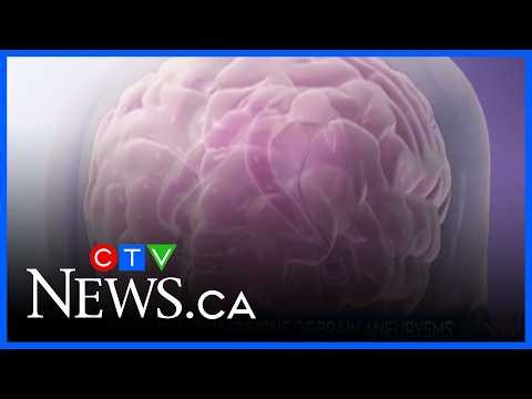 Brain aneurysm warning signs