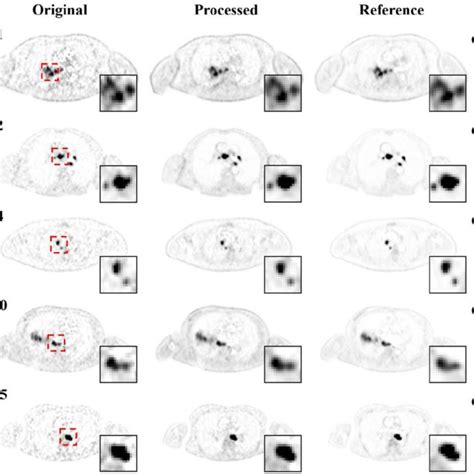 Results Of Ki Parametric Imaging For Patients 1 2 4 10 And 15