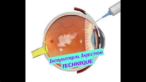 Intravitreal Injection Technique Procedure For Giving Injections