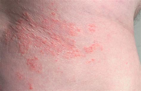 Inverse Psoriasis Vs Intertrigo Symptoms Causes And Identification