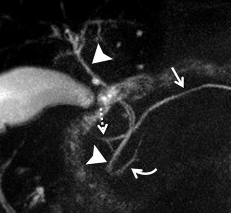 Annular Pancreas Ultrasound