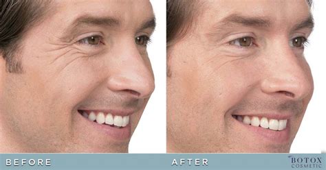 Botox For Men Dermatology Consultants