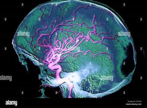 Vascularisation Cerebral Banque De Photographies Et Dimages à Haute