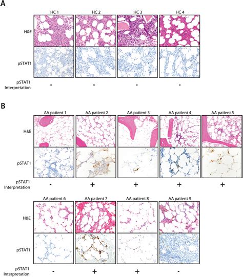 Jak Inhibition In A Patient With A Stat1 Gain Of Function Variant
