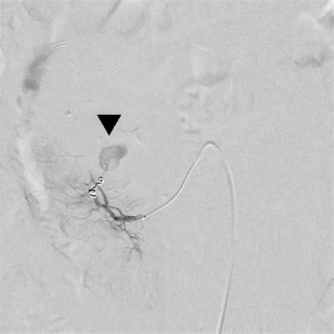 Digital Subtraction Angiogram Shows The Pseudoaneurysm Arrowhead