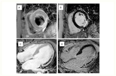Acute Myocardial Infarction On Cardiac Magnetic Resonance Top Row A