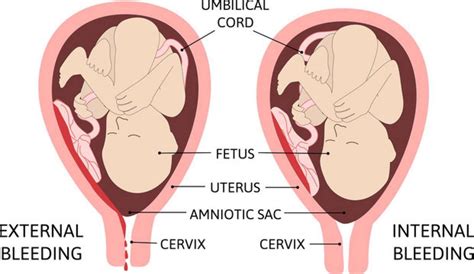 Subchorionic Hemorrhage Size Chart