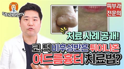 코 턱 비후성반흔 울퉁불퉁 여드름흉터 치료법은 수많은 치료 사례 Youtube