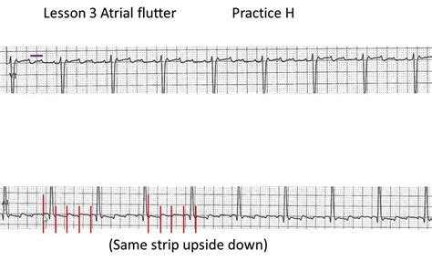 analyzing atrial flutter with a 4 1 conduction ratio youtube