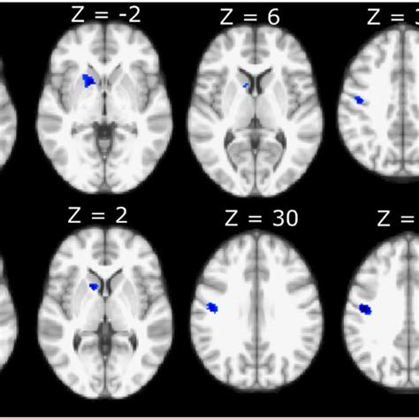 Correlation Map Between Mds Updrs Iii Axial Motor Subscores Severity