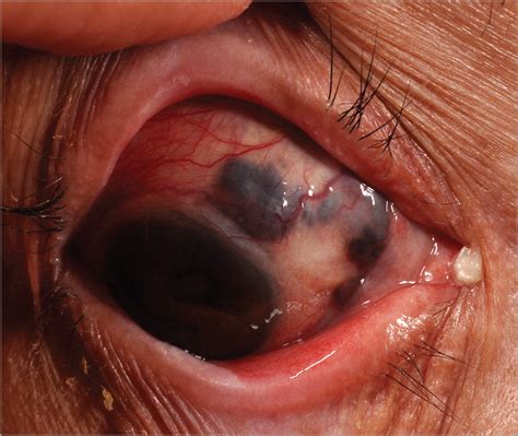 extrascleral spread of choroidal melanoma via tantalum marker suture