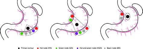 Laparoscopic Sentinel Node Navigation Surgery Involving Sentinel Basin