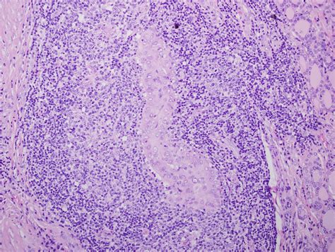 Pathology Outlines Diffuse Sclerosing Variant