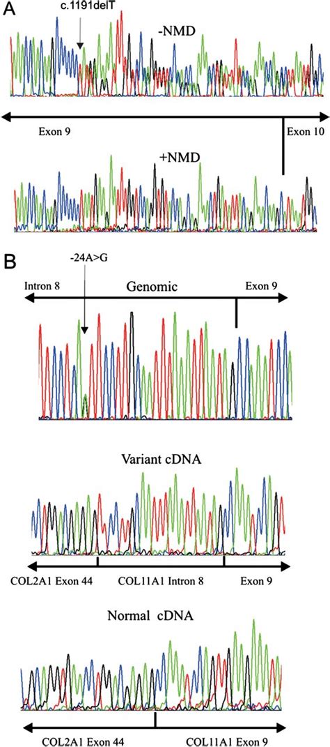 Analysis Of Exon 9 Mutations C 1191delt And C 991 24a G By Rt Pcr Rna