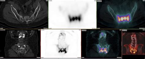 Use Of Spect Ct With 99mtc Mdp Bone Scintigraphy To Diagnose Sacral