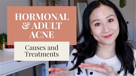 Treating Hormonal Acne Dermatologist Tips Youtube