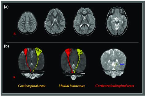 T2 Weighted Magnetic Resonance Images Upper Row And Diffusion Tensor