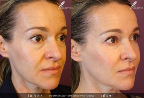Dermal Filler Treatment