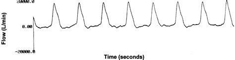 Measurement Of Cardiac Output Before And After Cardiopulmonary Bypass
