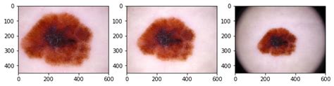 skin lesion image classification with deep convolutional