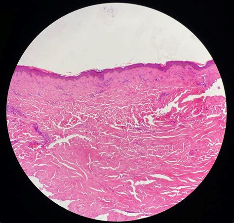 Histopathology Showing Homogenization Of The Whole Dermal Collagen With
