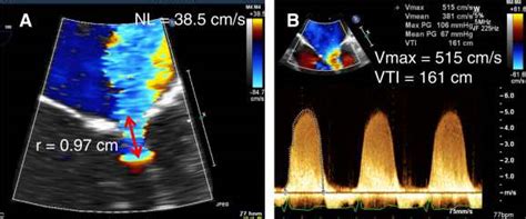 quantitative grading of the severity of mitral regurgitation mr in
