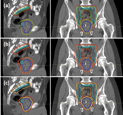 Optimal Image Guided Radiation Therapy Strategy For Organs At Risk
