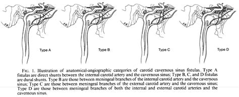 Barrow Klassifikation Für Carotis Cavernosus Fisteln Ars Neurochirurgica