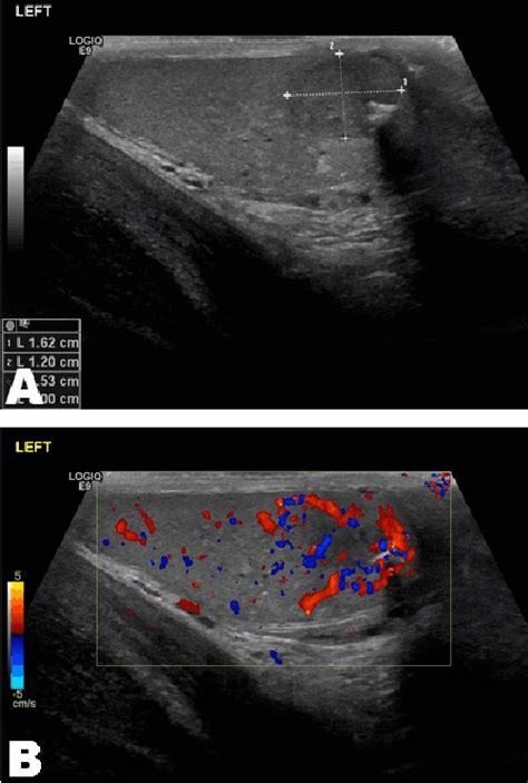 Ultrasound Scan Left Testis A Testicular Well Defined Solid Lesion