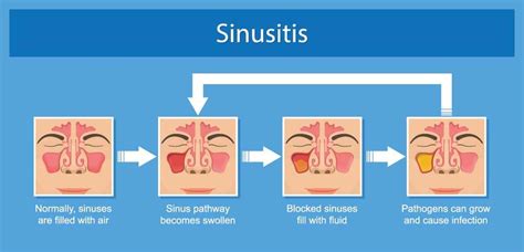 Chronic Sinusitis Philadelphia Symptoms Causes And Treatment
