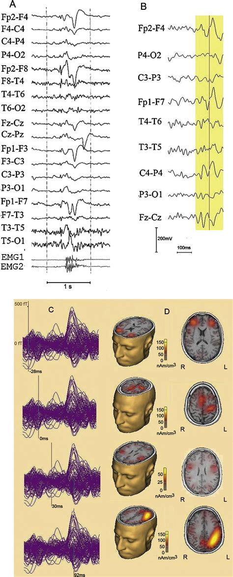 Temporal Recruitment Of Cortical Network Involved In Reading Epilepsy
