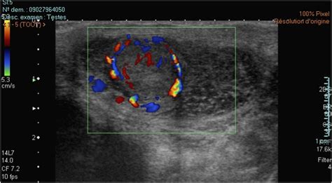 Colour Doppler And Ultrasound Characteristics Of Testicular Leydig Cell