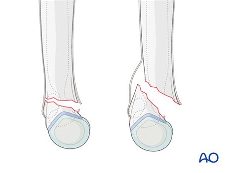 Open Reduction K Wire Fixation For Simple Metaphyseal Complete With
