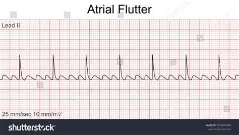 Atrial Flutter Ekg Ecg Interpretation Youtube