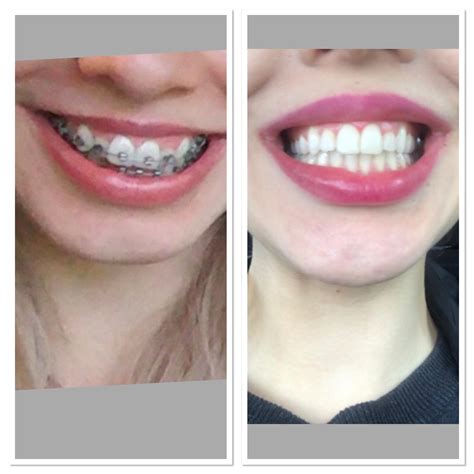 Got My Braces Off Today I Feel Amazing R Braces