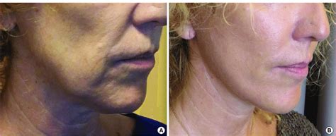 A B Preoperative And 6 Months Postoperative Photographs Download