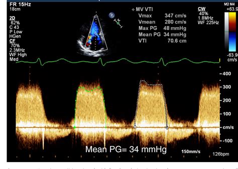 Gradient Echo Pulse Diagram