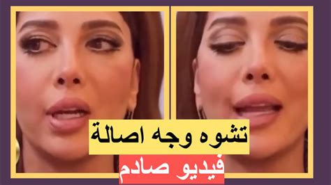تشوه وجه اصالة نصري بعد عملية التجميل في نيويورك ‼️ Youtube