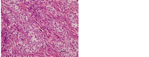 Malignant Extragastrointestinal Neuroectodermal Tumor Located At Right