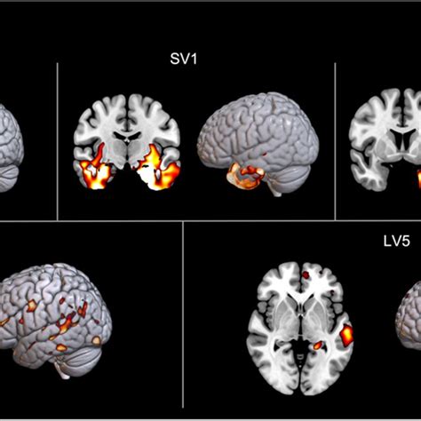 Results Of Whole Brain Voxel Based Morphometry Analysis Showing Atrophy