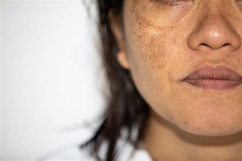 Tipos De Manchas En La Piel Fotos Y Principales Causas Tua Saúde
