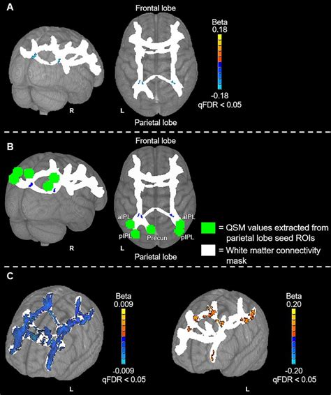 Voxel Wise Results Of The Parietal Lobe Qsm Vs Nd Analyses The