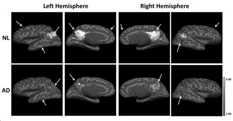 Comparison Of Resting State Connectivity Of The Dmn In Ad And Age Match