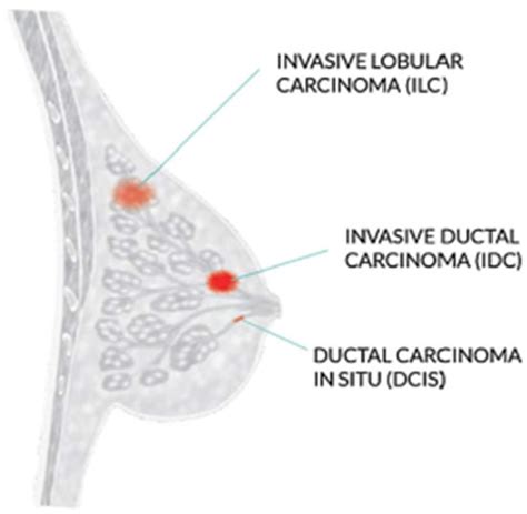 Diagnostics Free Full Text Breast Cancer Classification Through