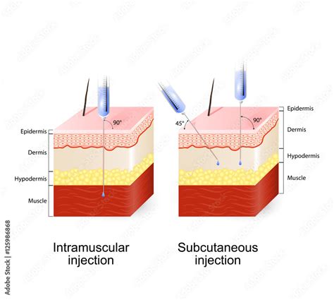 intramuscular injection and subcutaneous injection vector de stock