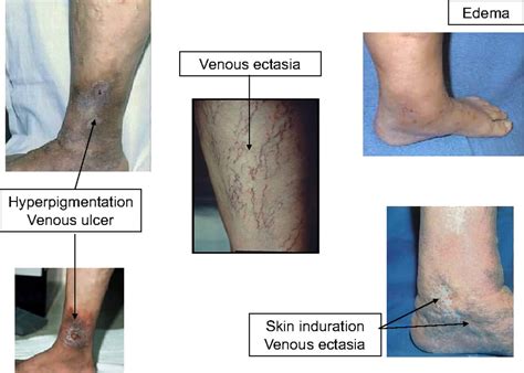 Are Superficial Thrombophlebitis And Deep Vein Thromb