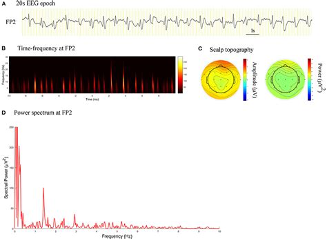 Frontiers Can Spectral Power Be Used As A Candidate Seizure Marker Of