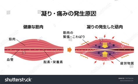 Osgood Schlatter Disease Knee Joint Disease Illustration Stock Vector
