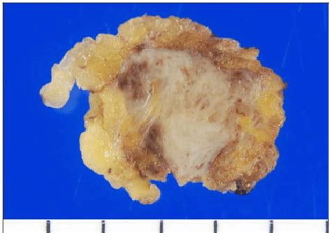 In The Macroscopic Findings Of The Resected Specimen The Tumor Is
