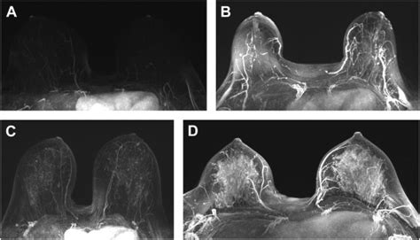 Background Parenchymal Enhancement Radiologic Clinics